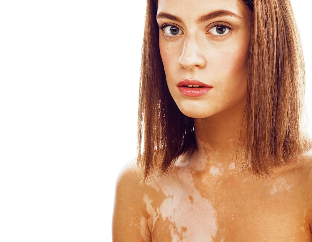 What is Vitiligo? | Recouleur® Vitamins for Vitiligo